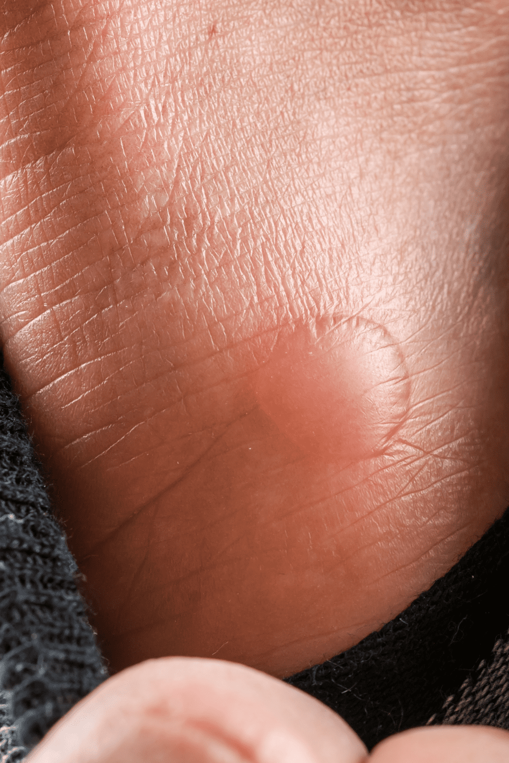 Blisters From Running: How to Treat & Prevent Blisters