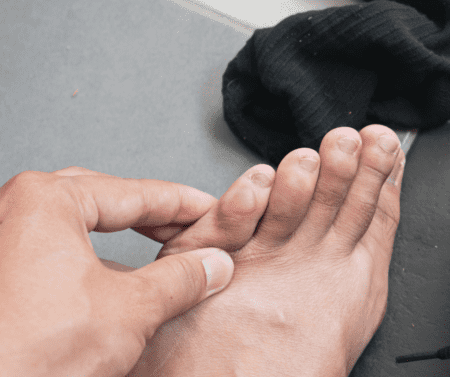 Blisters From Running: How to Treat & Prevent Blisters