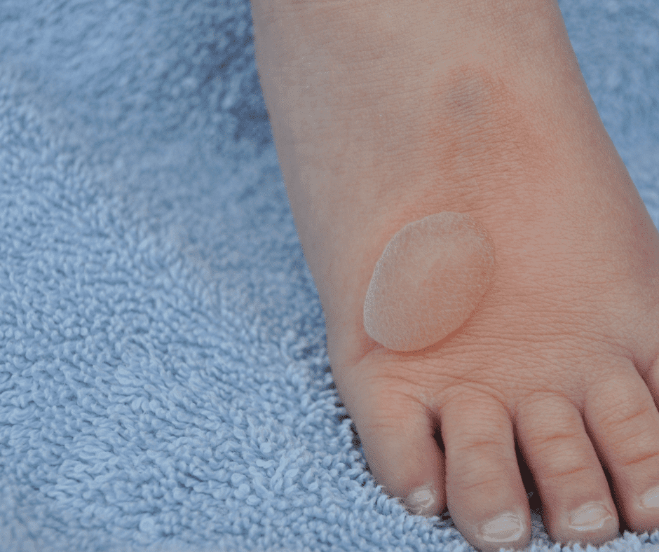 Blisters From Running: How to Treat & Prevent Blisters