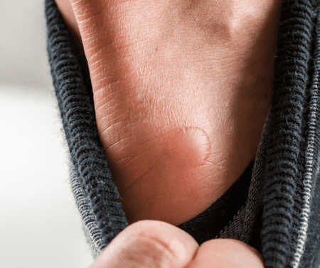 Blisters From Running: How to Treat & Prevent Blisters