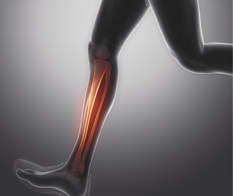 Fibula Stress Fracture: How To Get Back Into Running SAFELY
